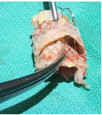 Explant of a transcatheter valve-in-transcatheter valve with ...