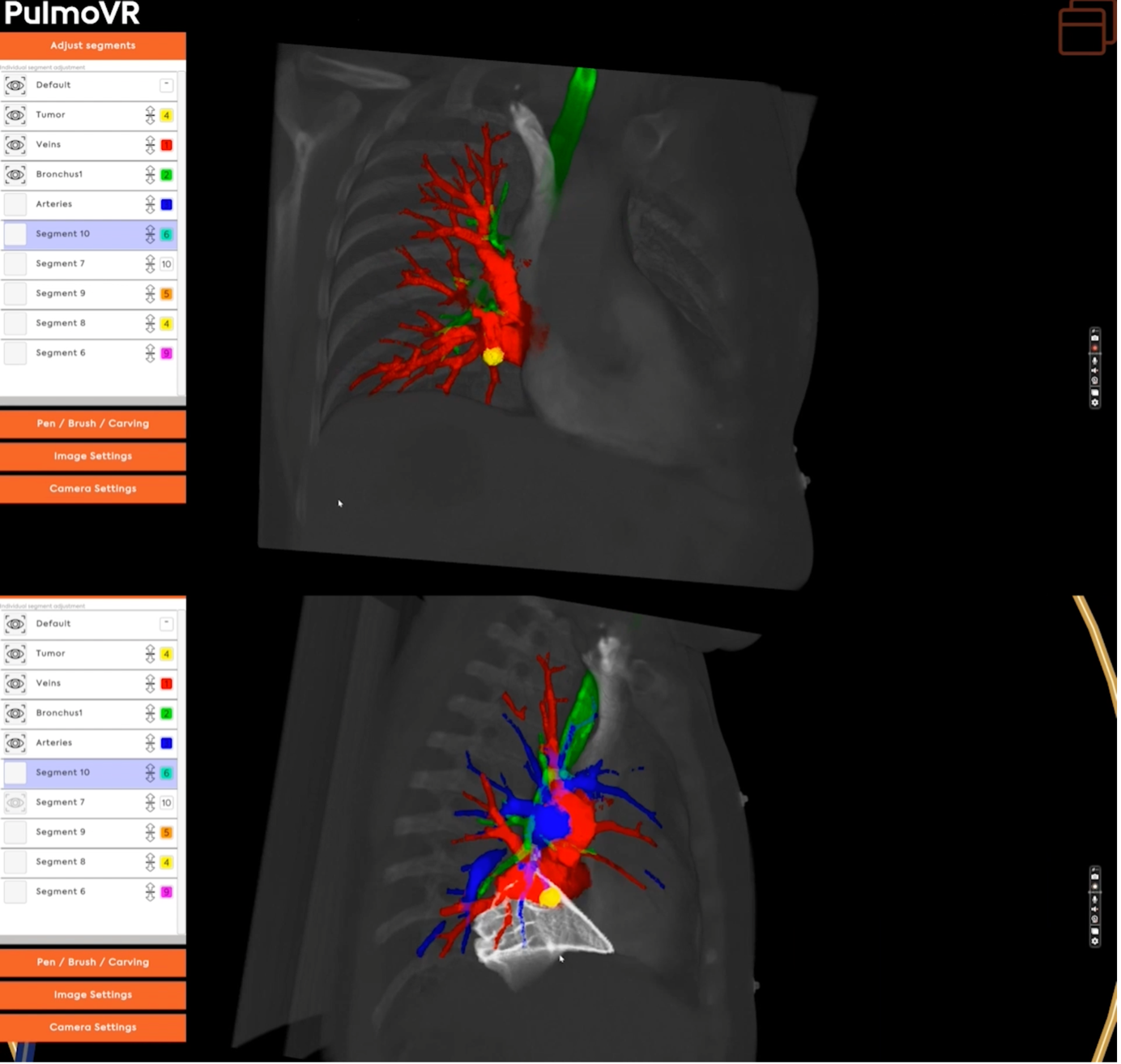 Video-assisted thoracic surgery S7 segmentectomy: use of virtual ...