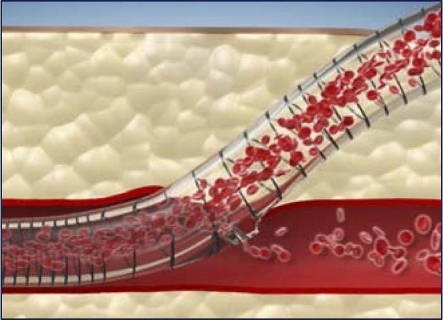 Femoral cannulation for cardiopulmonary bypass with a novel ...