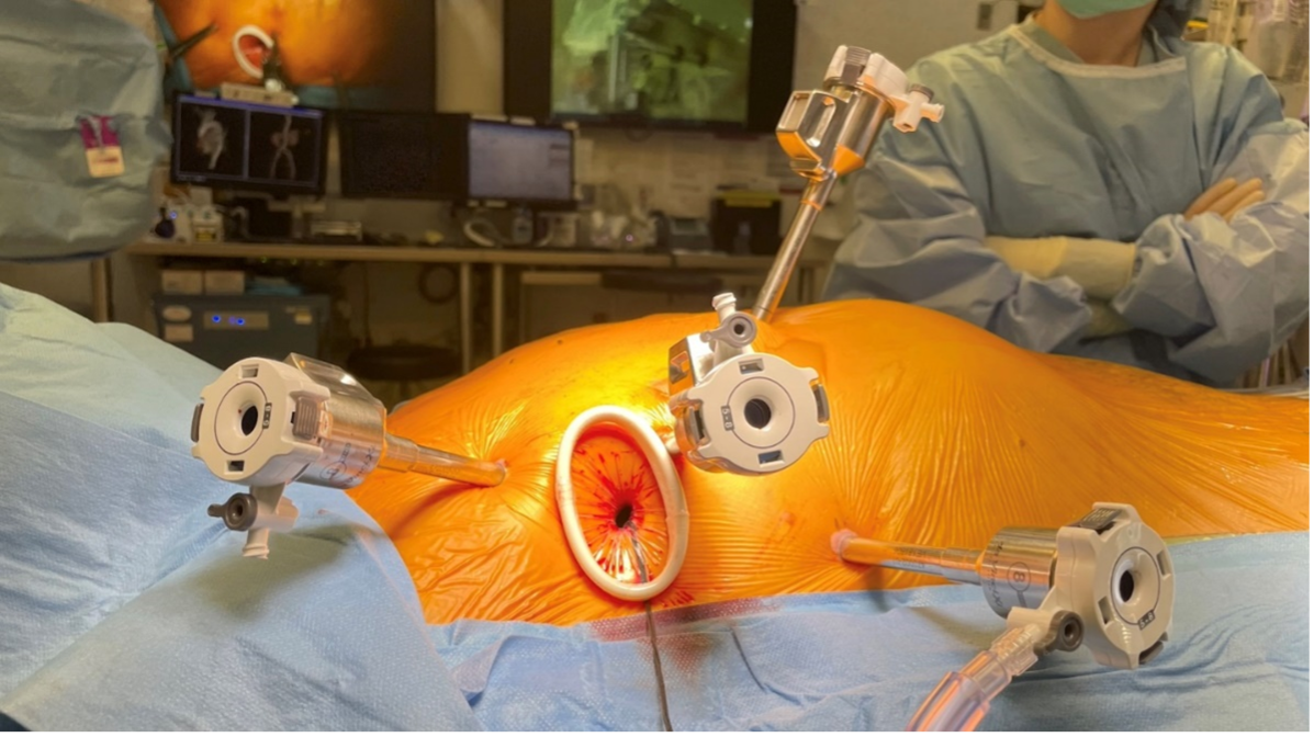 Robotic endoscopic transmitral septal myectomy and concomitant mitral ...