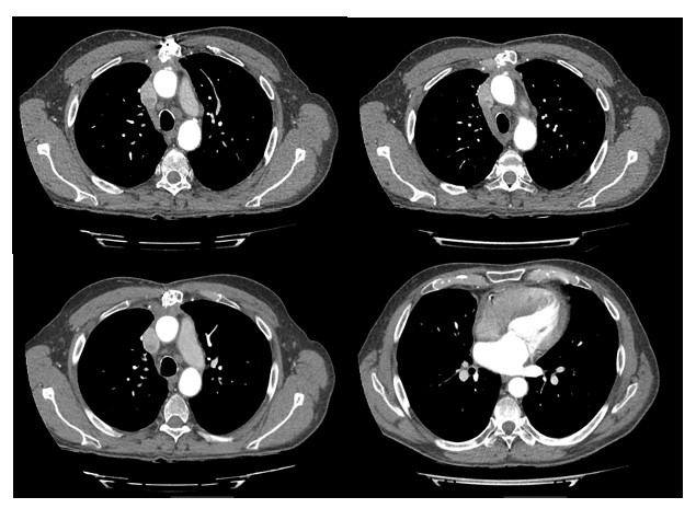 Root-commando operation for multivalvular endocarditis and ...