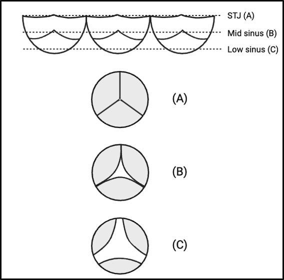 Striving for physiologic coaptation: An experimental and innovative ...