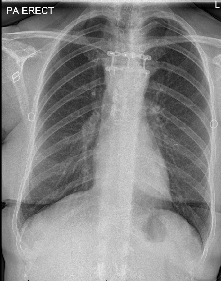 Manubriectomy made easy | MMCTS